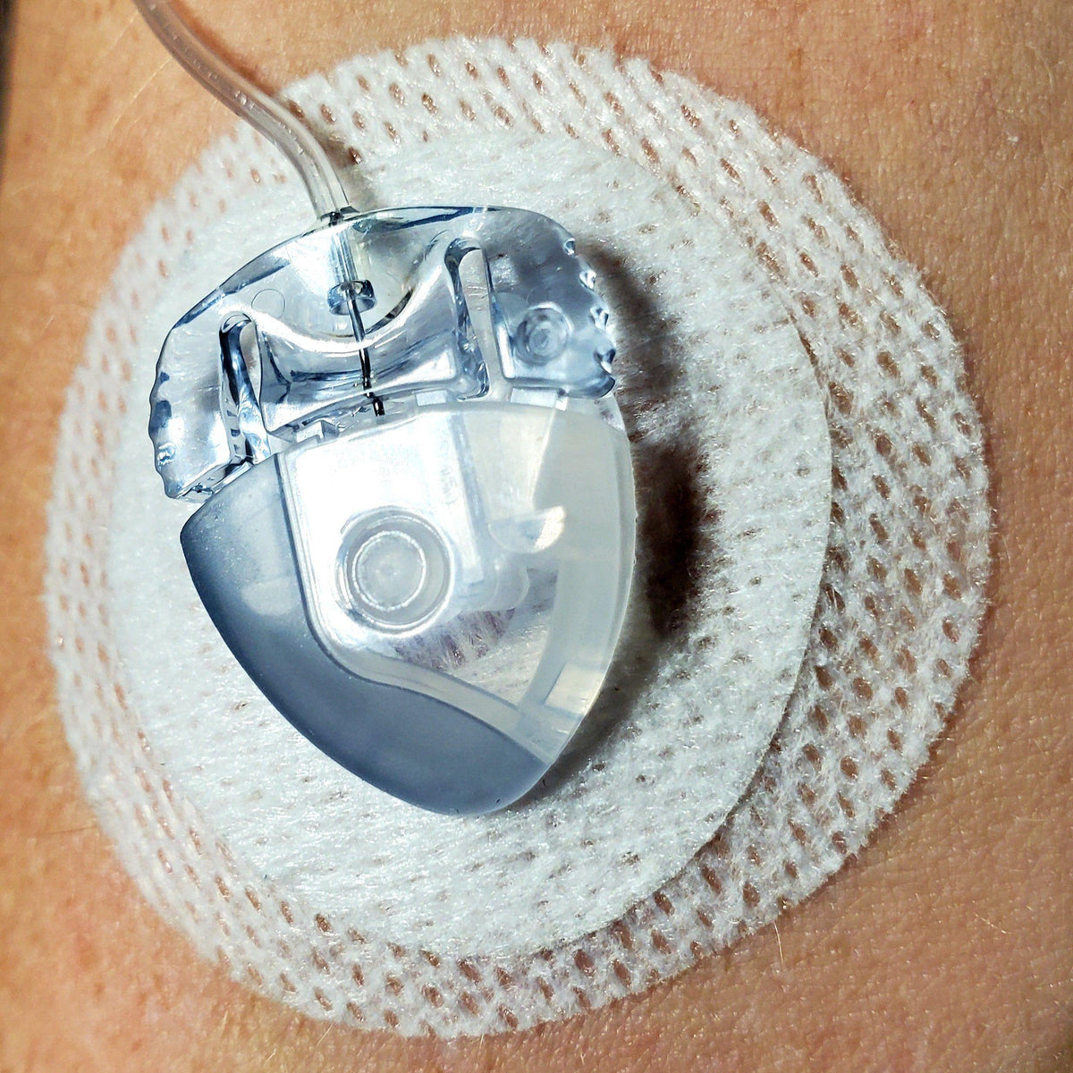 Skin Barrier For T-Slim & Medtronic Cannula : Adhesive Underlay Patch ...